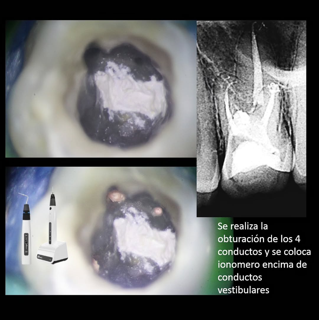 Reporte de caso: Sellado de perforación en furcación en molar superior ...