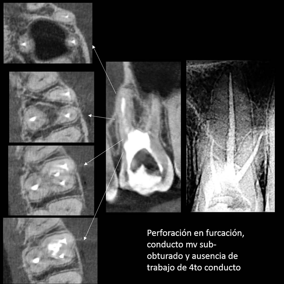 Reporte de caso: Sellado de perforación en furcación en molar superior ...